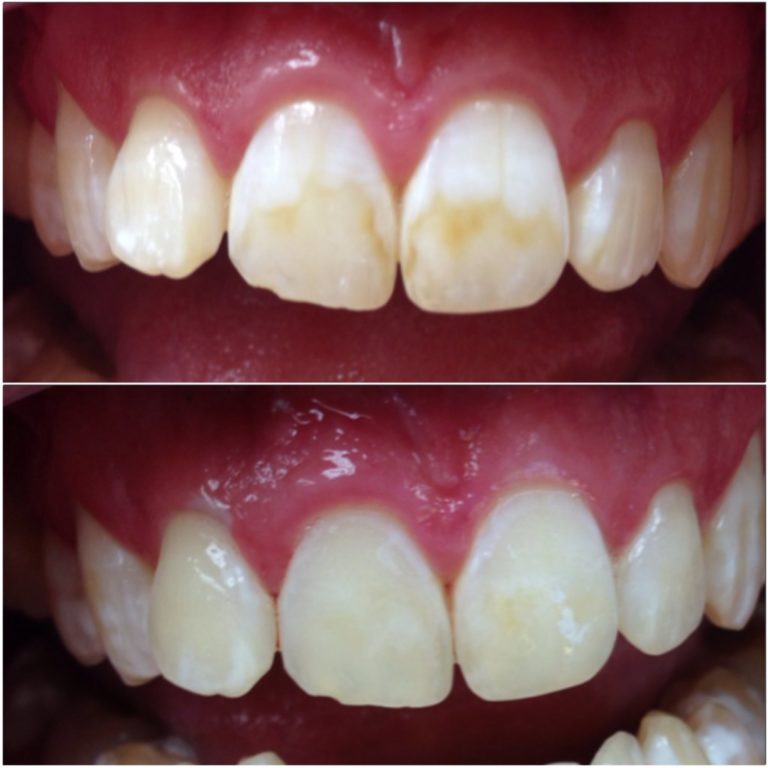 Icon White Spot Removal Hunterdon County & Clinton NJ