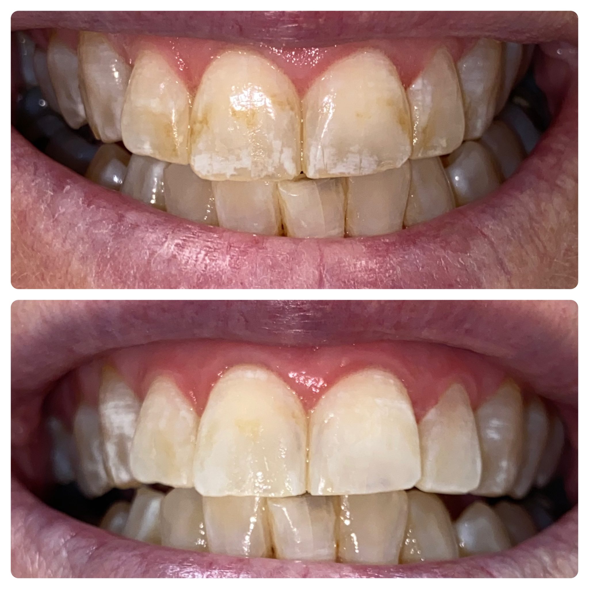 Icon White Spot Removal Hunterdon County & Clinton NJ